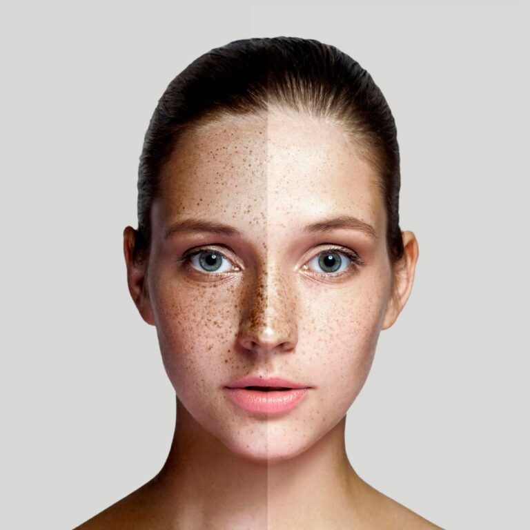 Top 10 Treatments for Scar & Pigment Correction